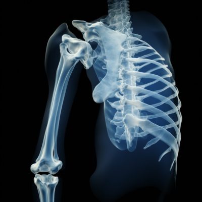 Most Common Complications of a Humerus Fracture